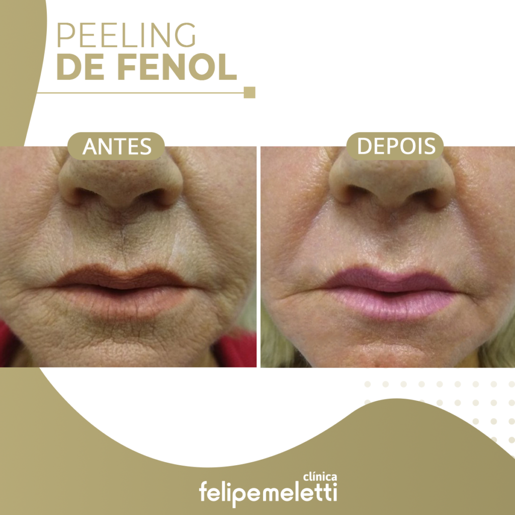 Peeling de Fenol - Rejuvenesça anos em meses - Clínica Felipe Meletti