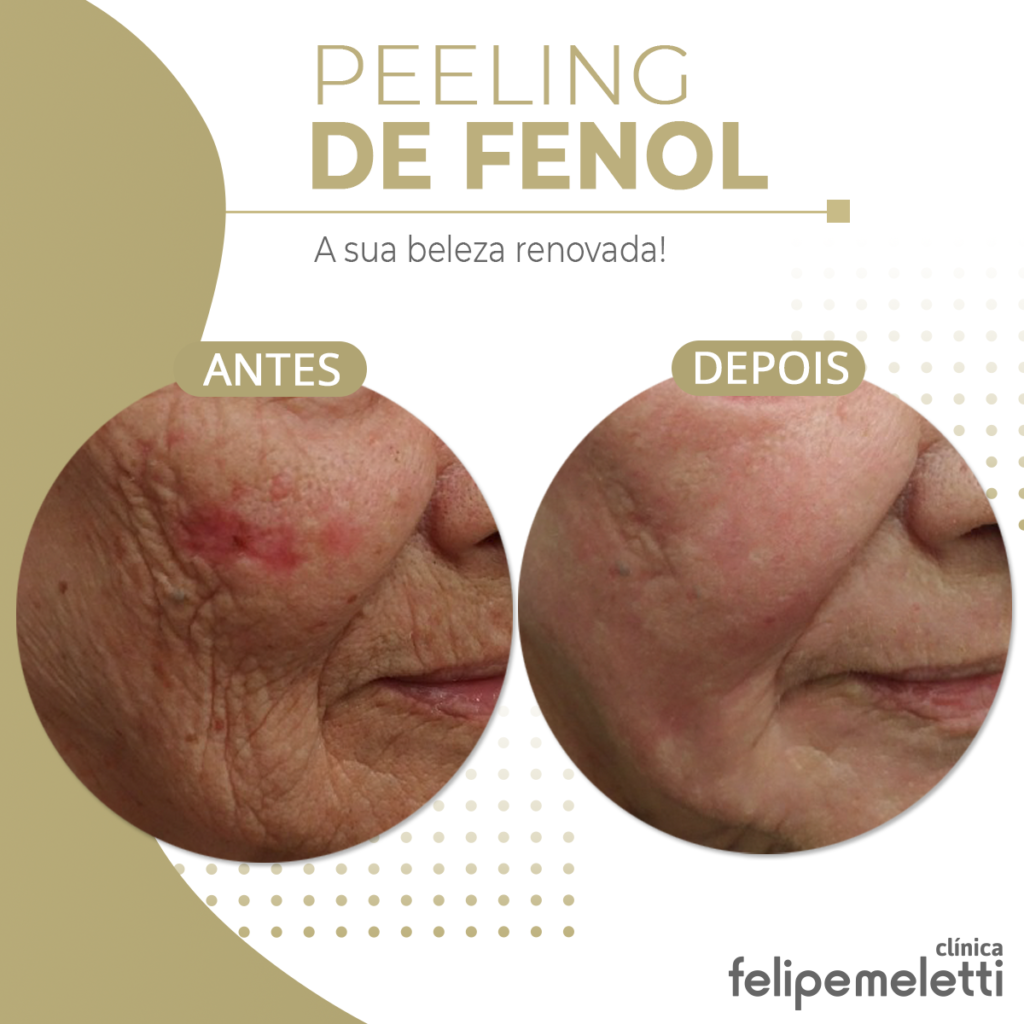 Peeling de Fenol - Clínica Felipe Meletti