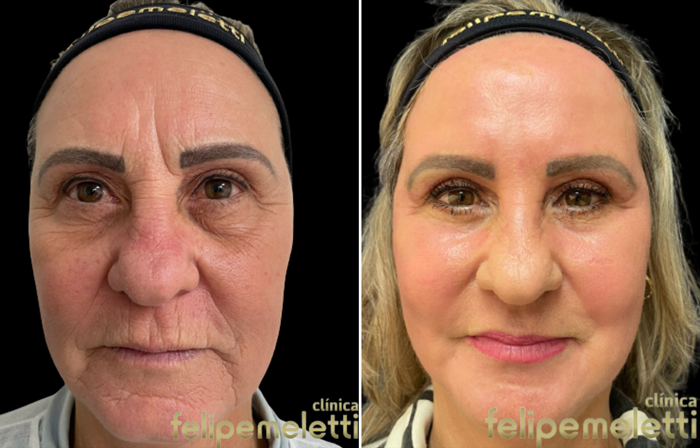PEELING DE FENOL (RESTART FACIAL) - Clínica Felipe Meletti