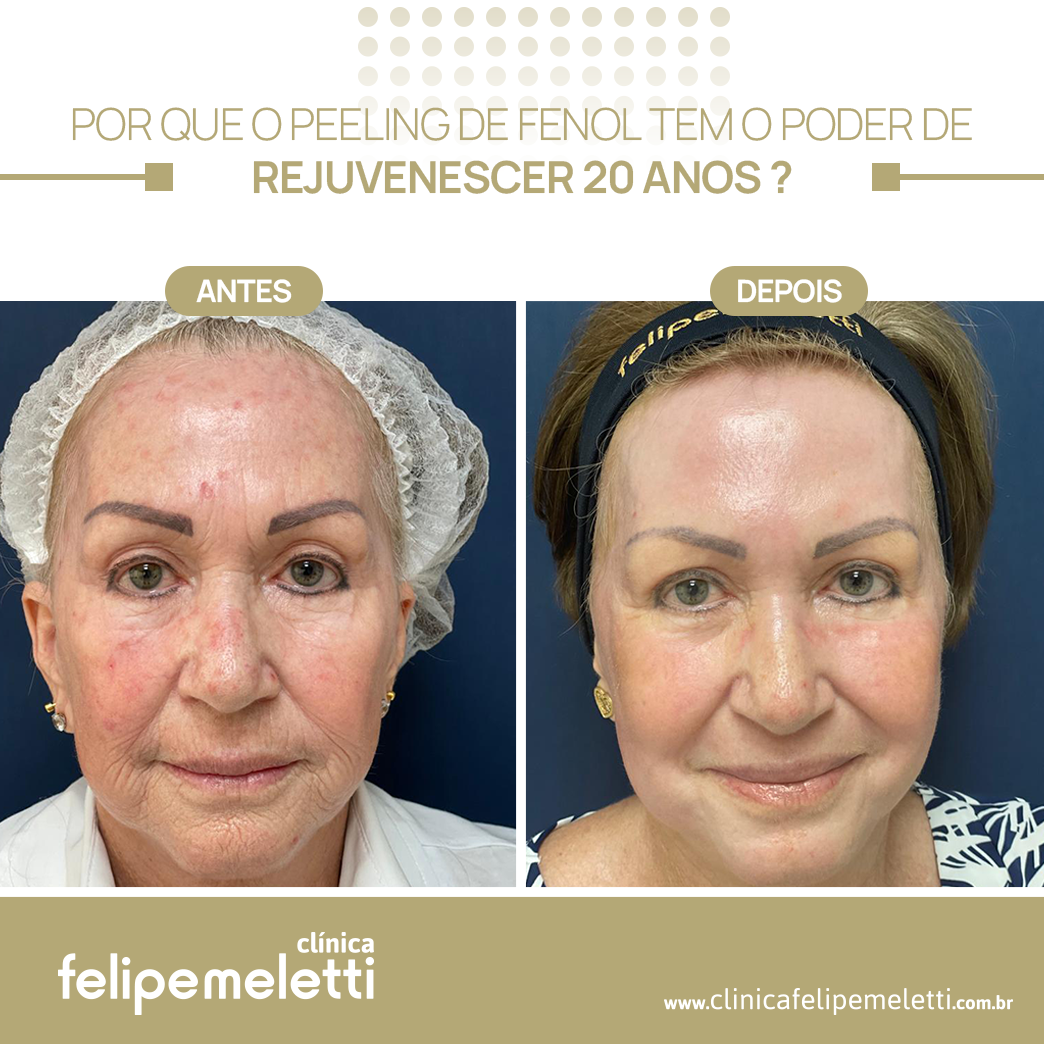 Por que o Peeling de Fenol tem o poder de rejuvenescer 20 anos ...